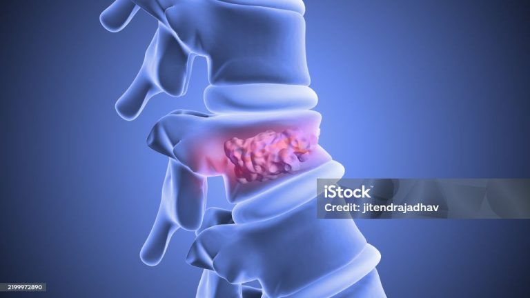 Discogram / Discography | Link Radiology Bulk Billed Imaging - Link ...