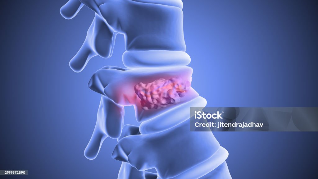 Discogram / Discography | Link Radiology Bulk Billed Imaging - Link ...