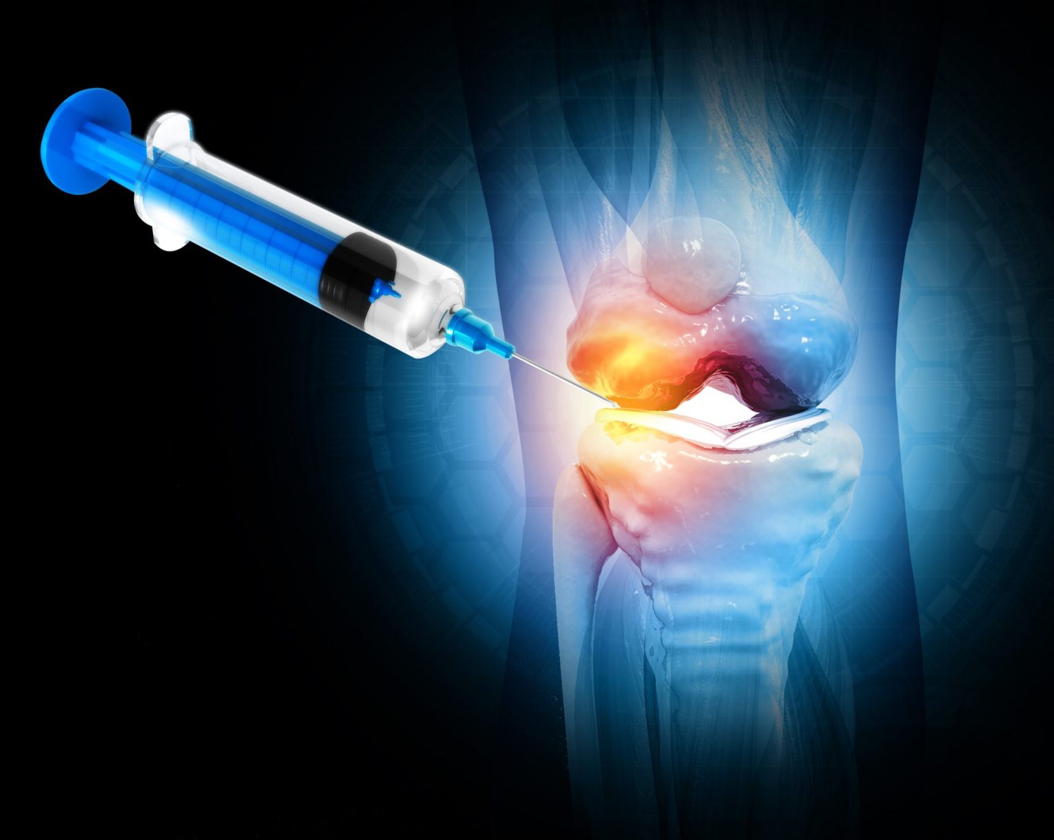 Euflexxa Injections | Link Radiology Bulk Billed Care - Link Radiology